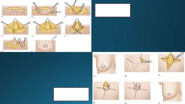 Nursing responsibility beast reconstruction.pptx