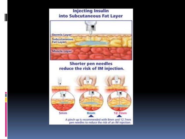 nursing skill injeksi insulin procedure.ppt