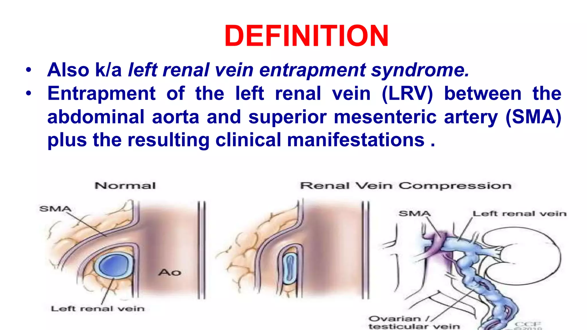 Nutcracker syndrome | PPTX