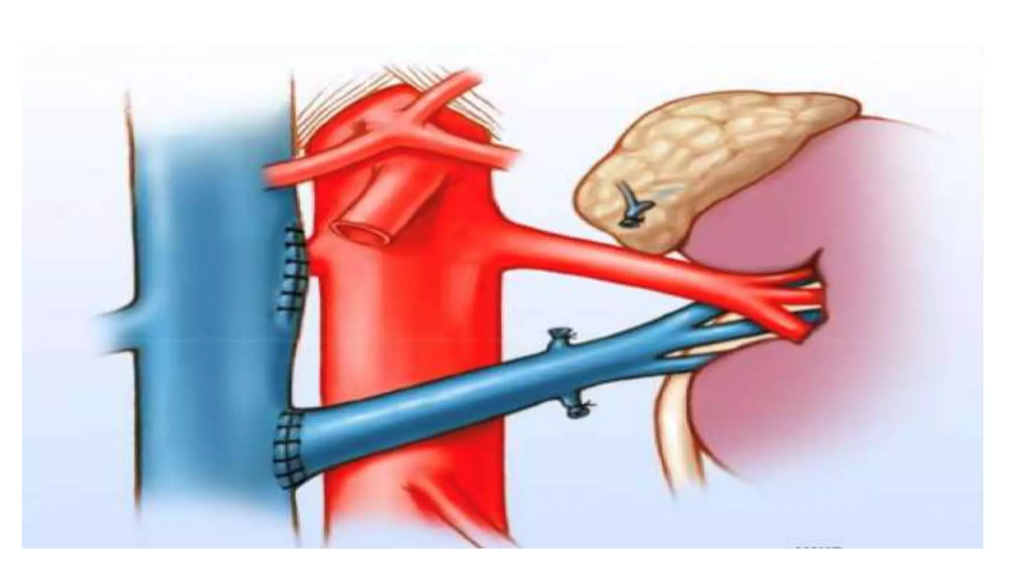 Nutcracker syndrome | PPTX