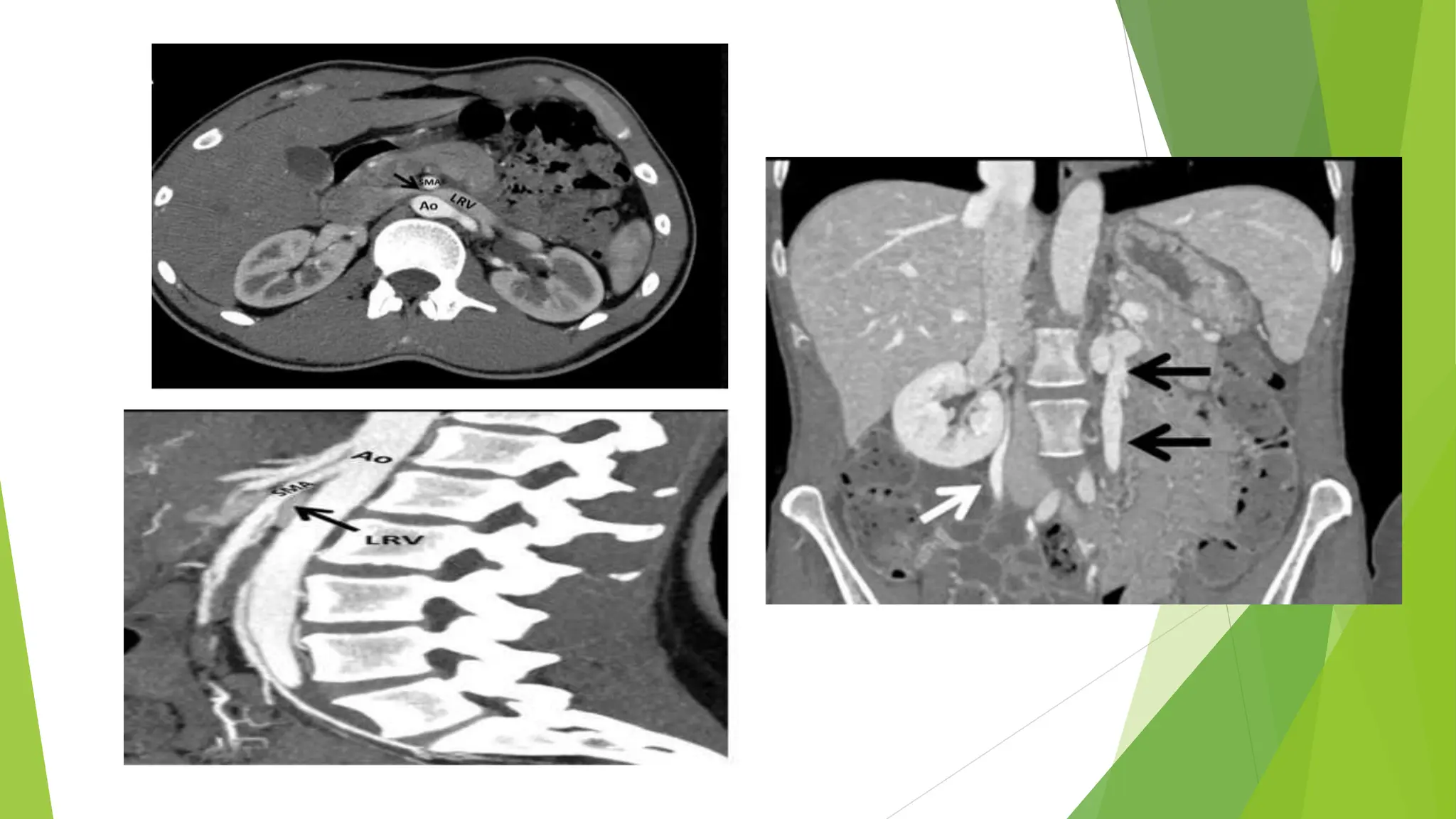 Nutcracker Syndrome And Its Management Pptx