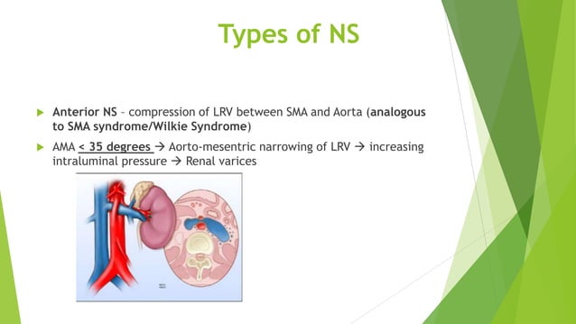 Nutcracker syndrome and its management.pptx