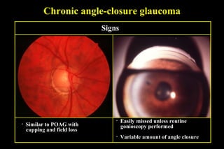 29 primary angle closure glaucoma | PPT