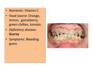 Nutrients & Deficiency disease | PPTX