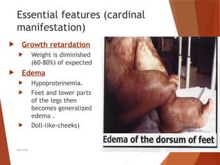 Nutrition and Malnutrition lecture .pptx