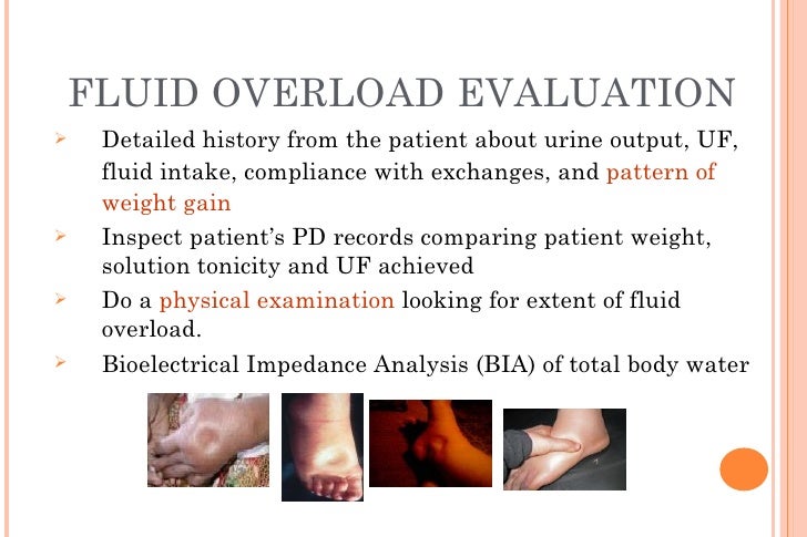 Nutrition in Peritoneal Dialysis