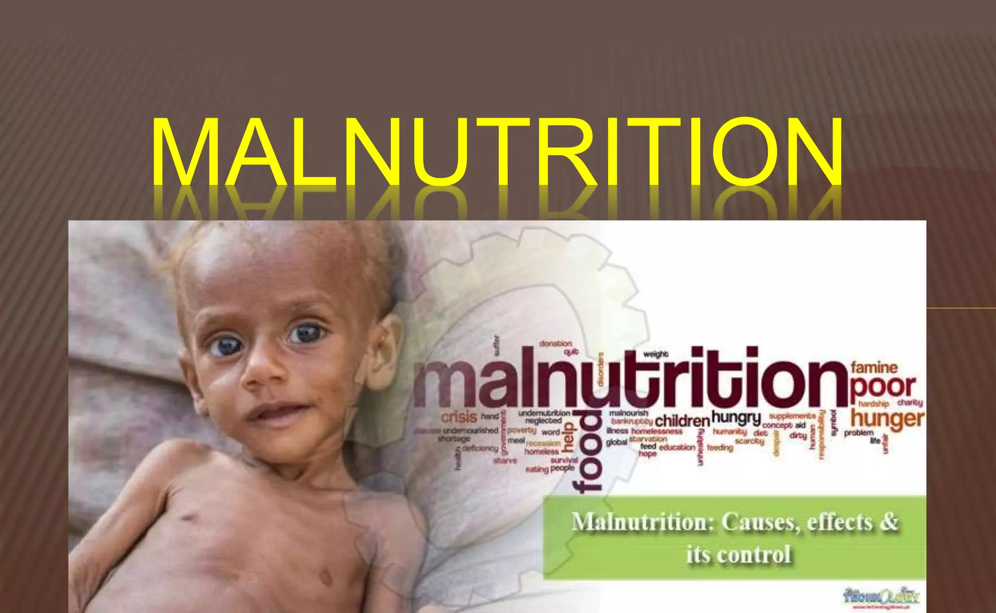 Malnutrition | PPT
