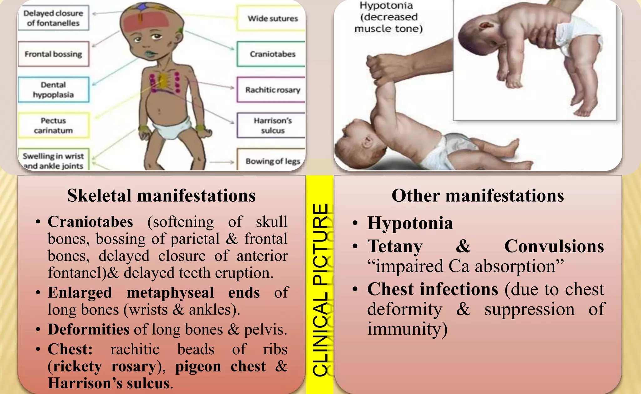 Malnutrition | PPT