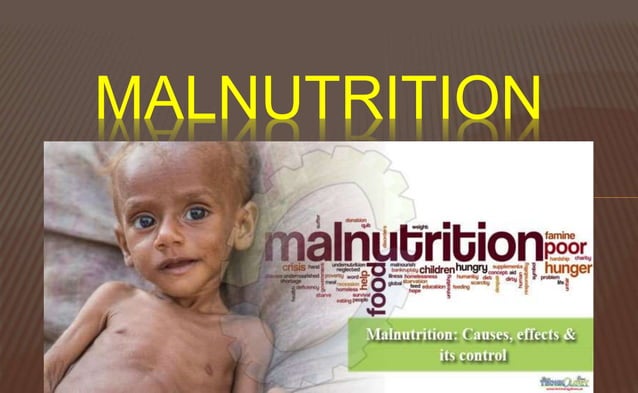 Malnutrition | PPT | Bone and Joint Conditions | Diseases and Conditions