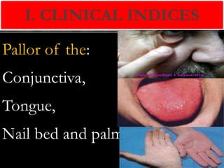 Nutritional anemia -Dr JP Singh, Dept, of community medicine, SRMS IMS ...