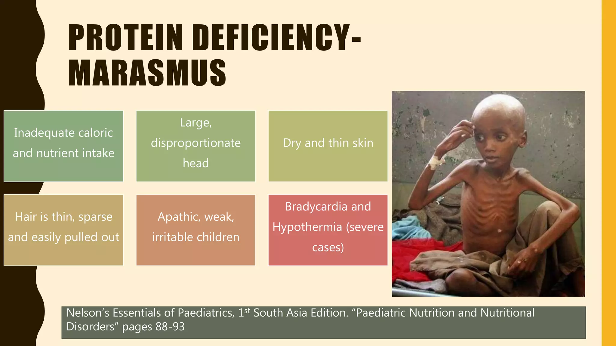 NUTRITIONAL DEFICENCYS IN CHILDREN.pdf