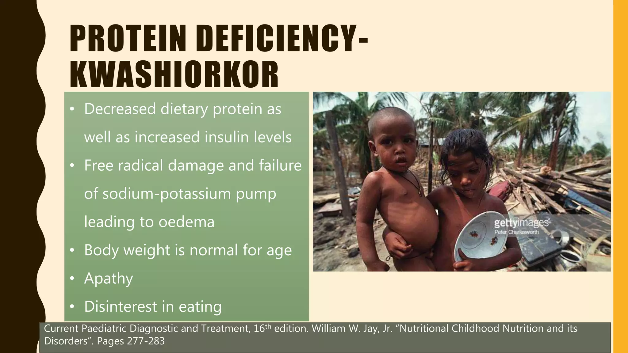 NUTRITIONAL DEFICENCYS IN CHILDREN.pdf