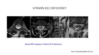 NUTRITIONAL DEFICIENCIES IN POVERTY Radiology.pptx