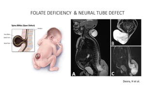 NUTRITIONAL DEFICIENCIES IN POVERTY Radiology.pptx