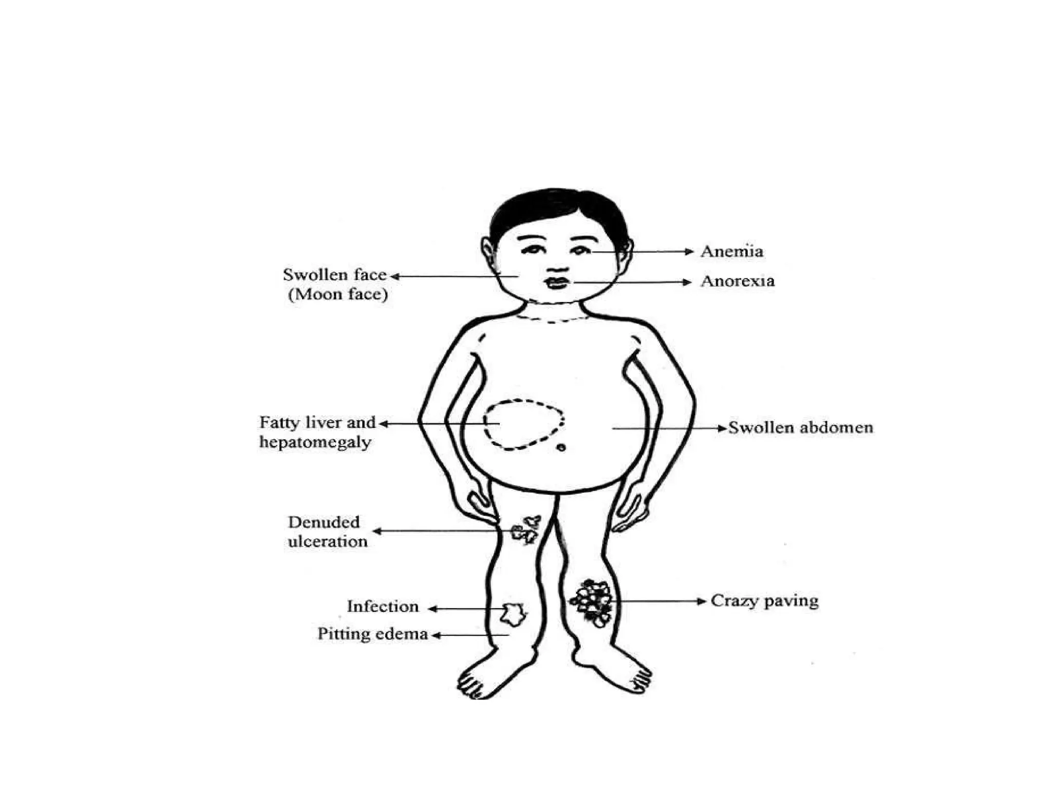 nutritional deficiency diseases.pptx.... | PPT