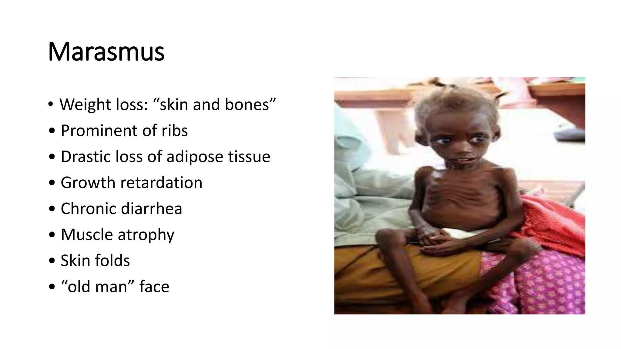 Nutritional deficiency disorders in children | PPTX