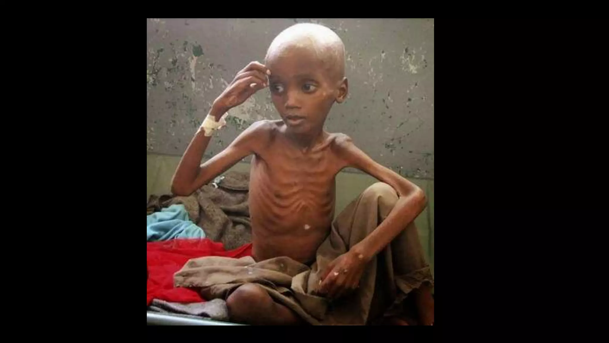 Nutritional disease | PPTX