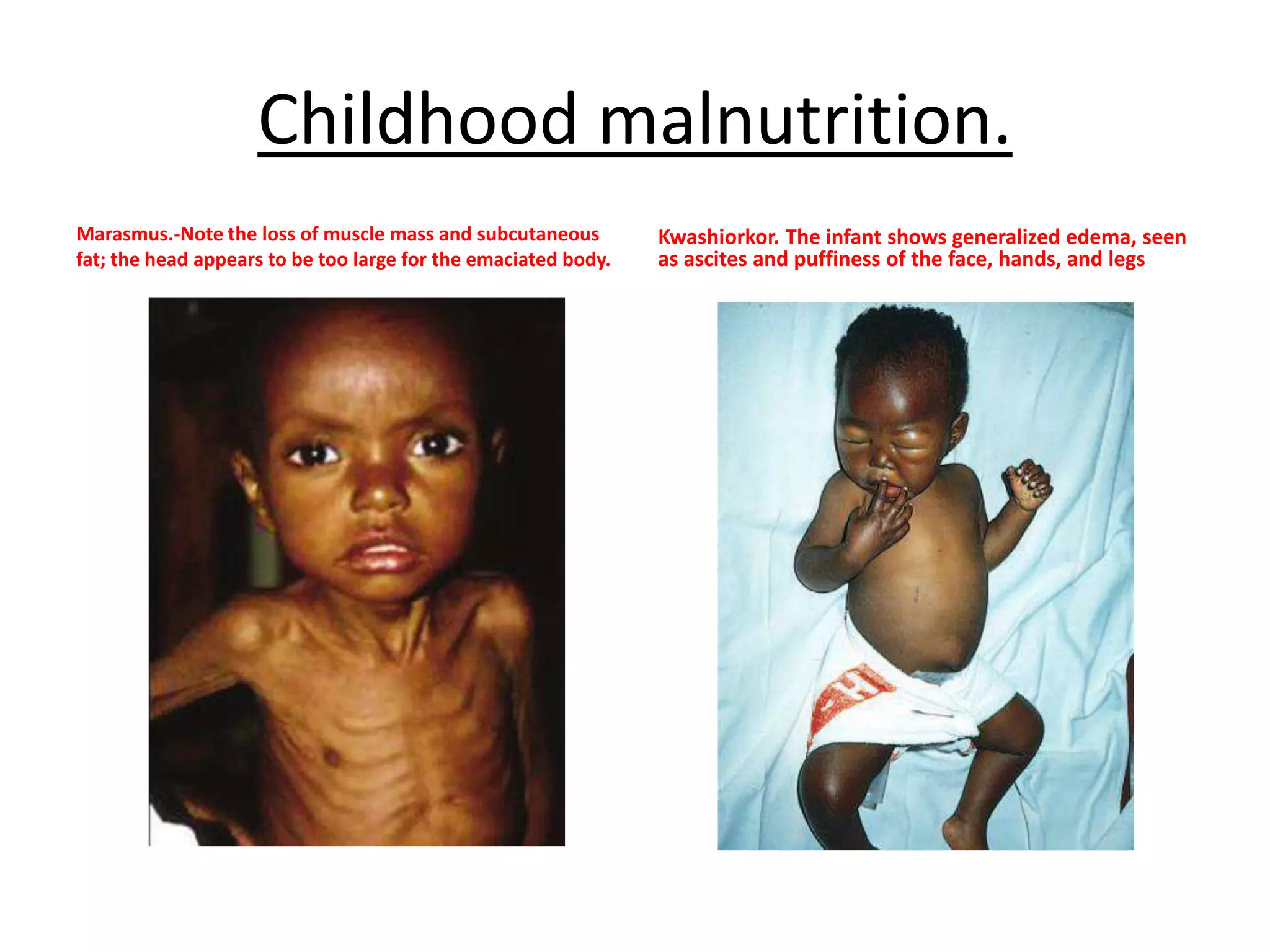 Nutritional diseases.pptx
