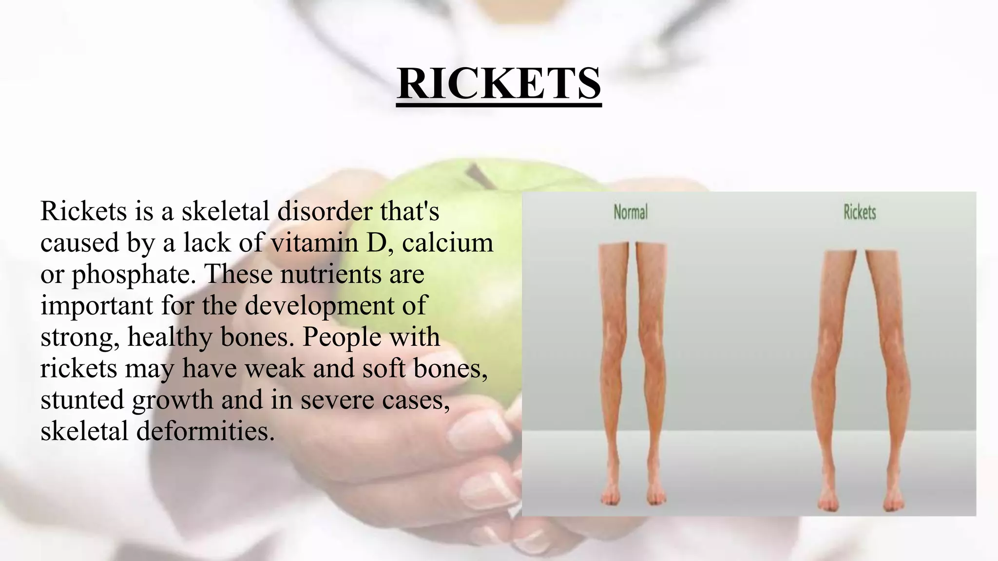 NUTRITIONAL DISORDERS AND PROTEIN ENERGY MALNUTRITION | PPTX