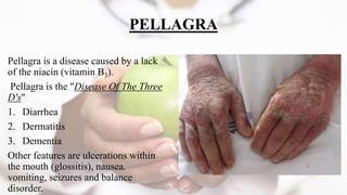 NUTRITIONAL DISORDERS AND PROTEIN ENERGY MALNUTRITION | PPTX