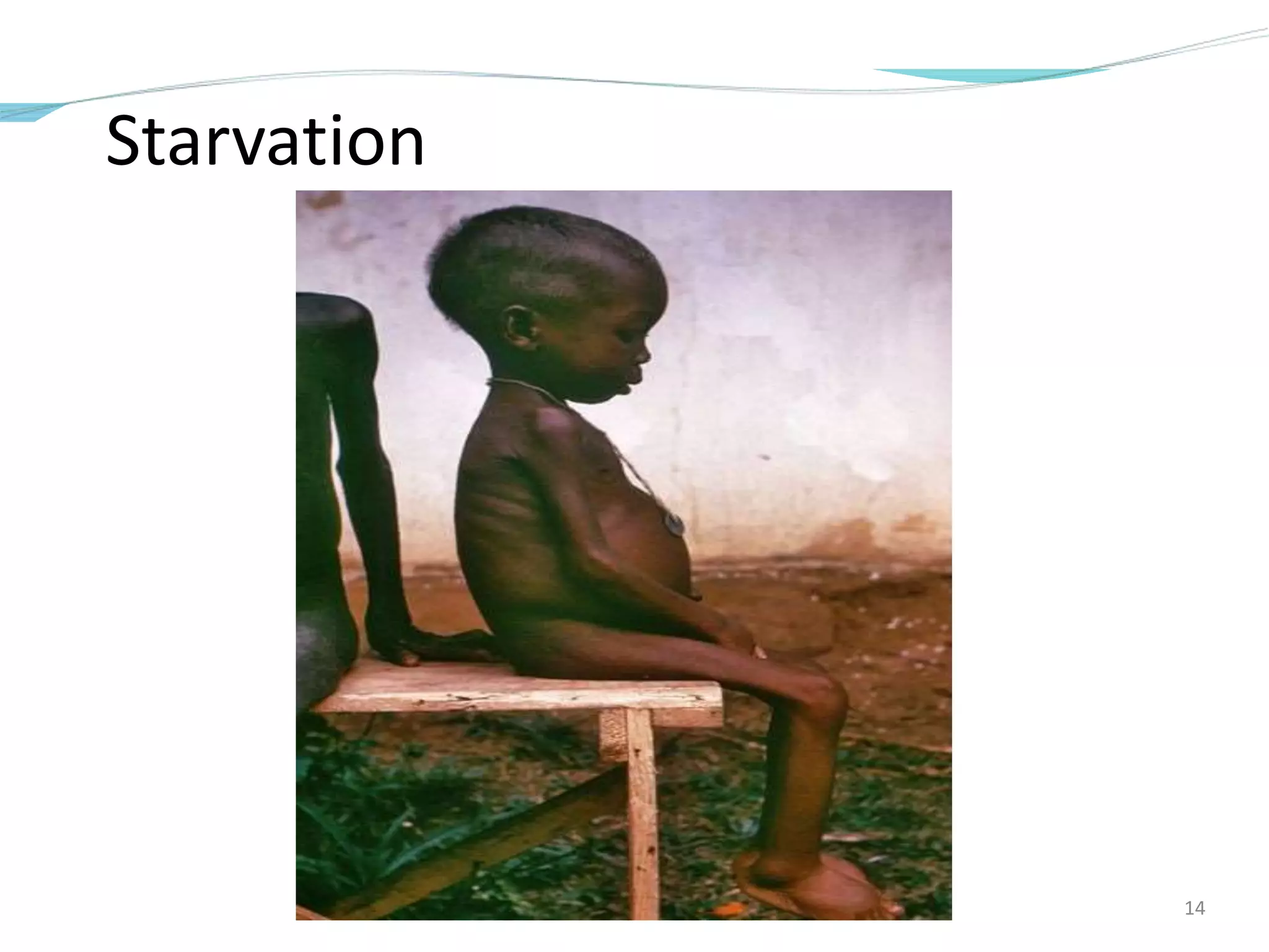 Nutritional disorders | PPT