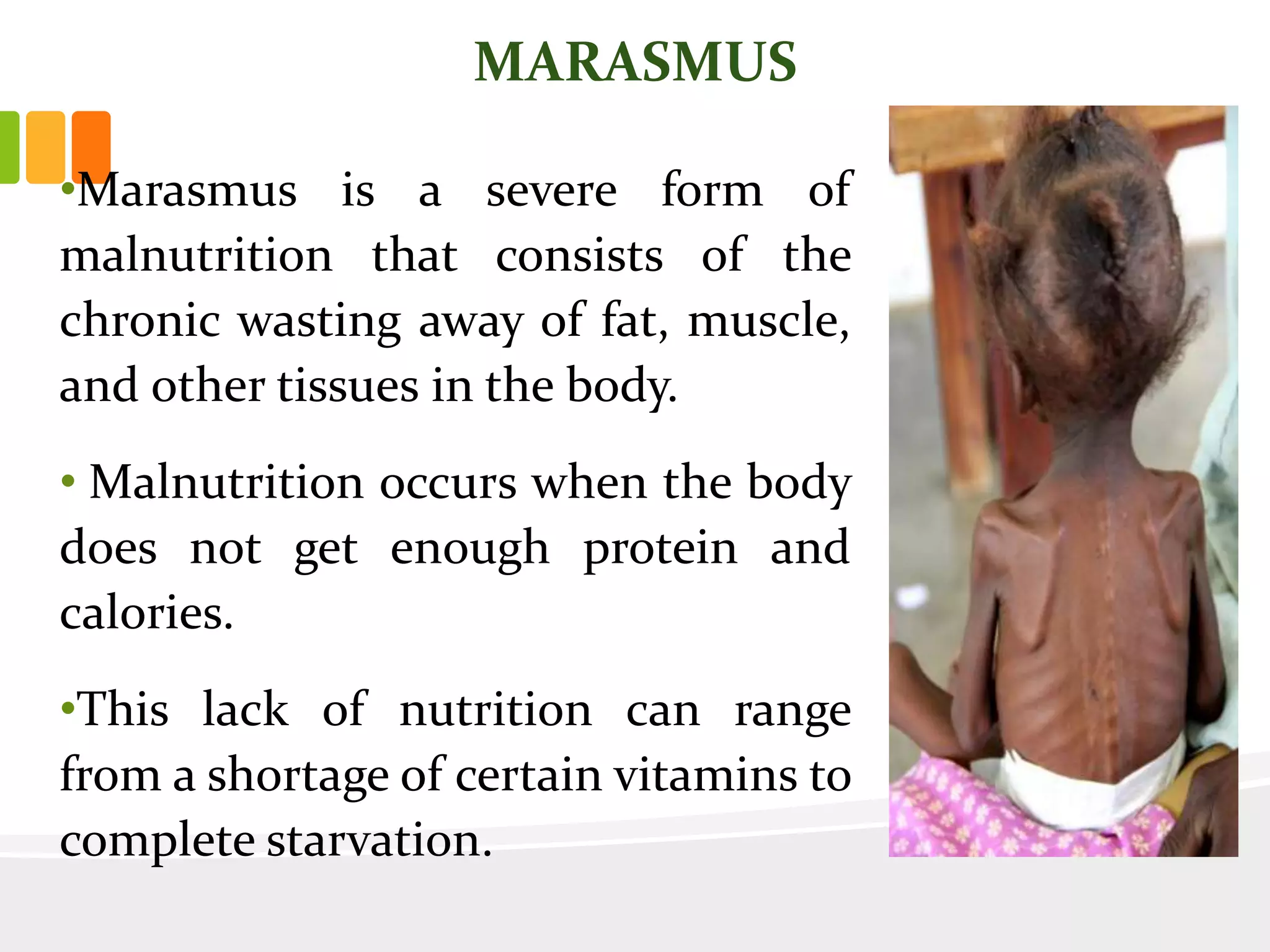 Nutritional problems ppt | PPTX