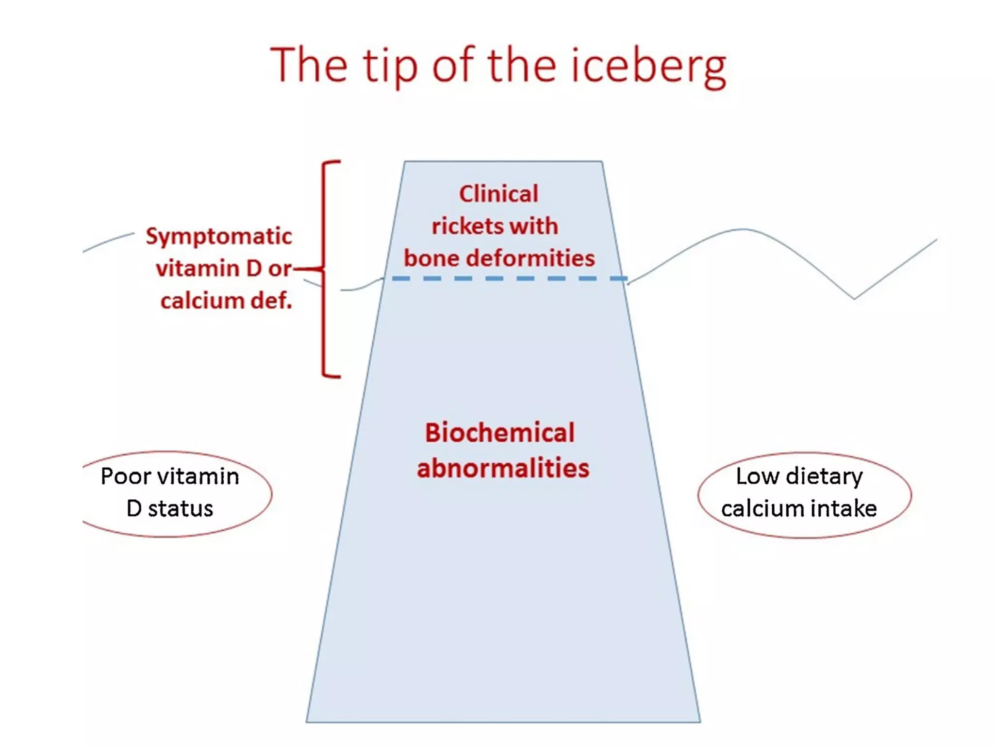 Nutritional rickets | PPT