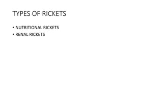 Nutritional rickets | PPTX