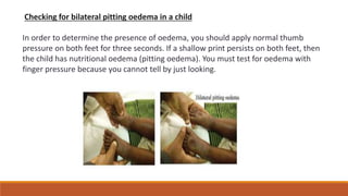 Nutritional status of infants | PPTX