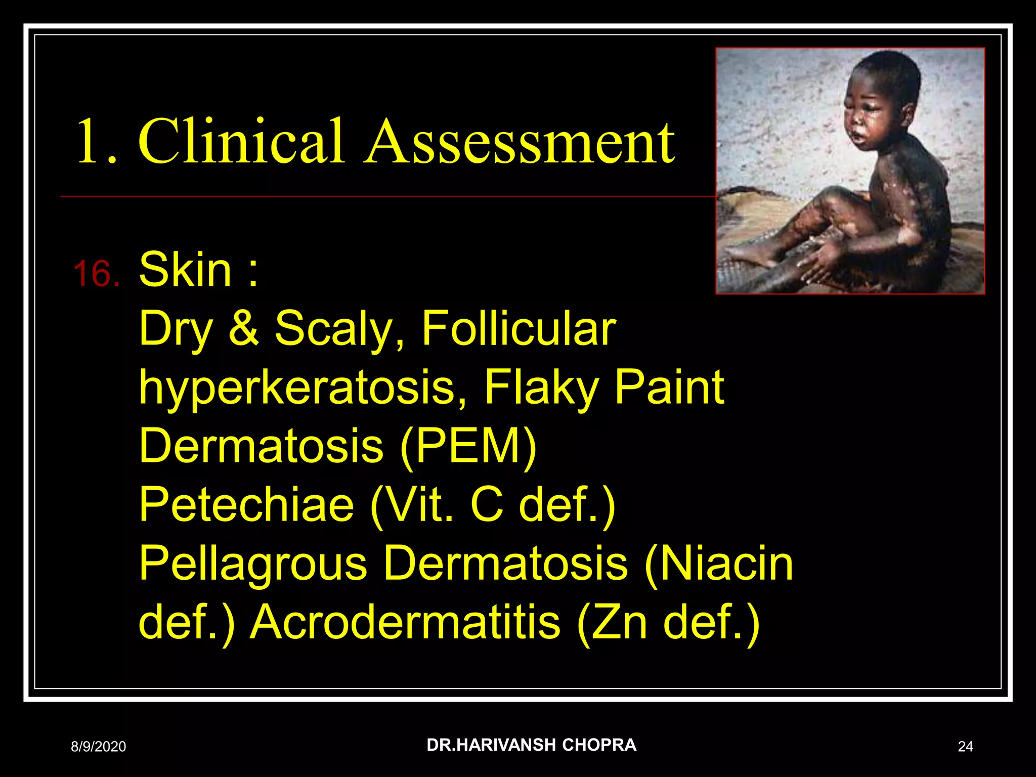 Nutrition assessment in children- dr harivansh chopra | PPT