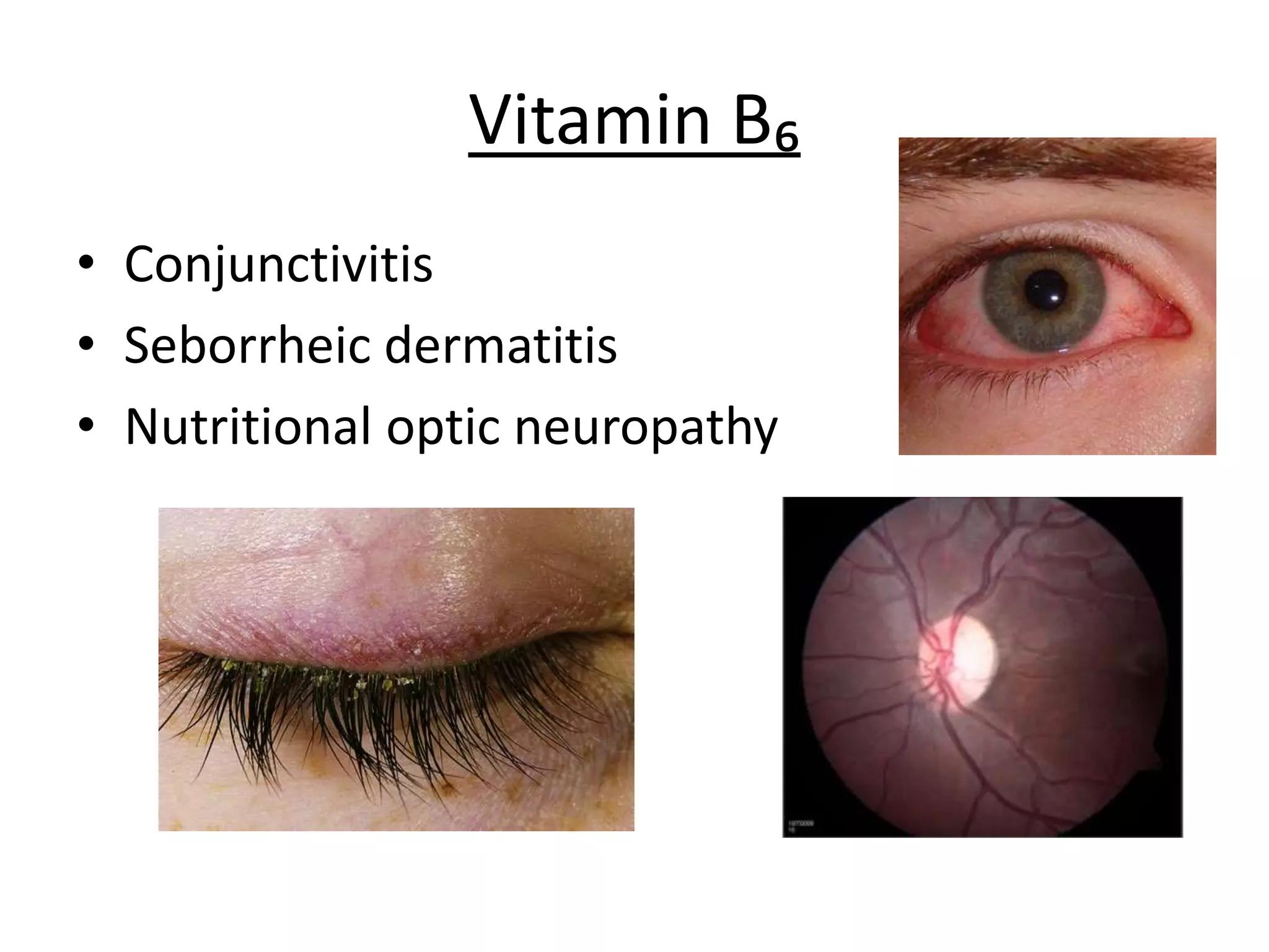 Nutrition deficiency effects on the eyes | PPTX