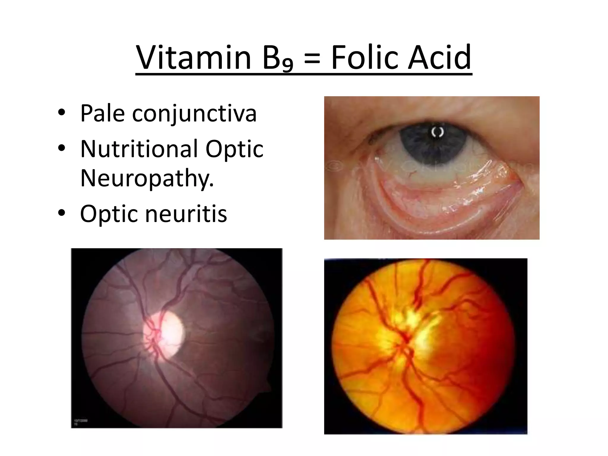 Nutrition deficiency effects on the eyes | PPTX