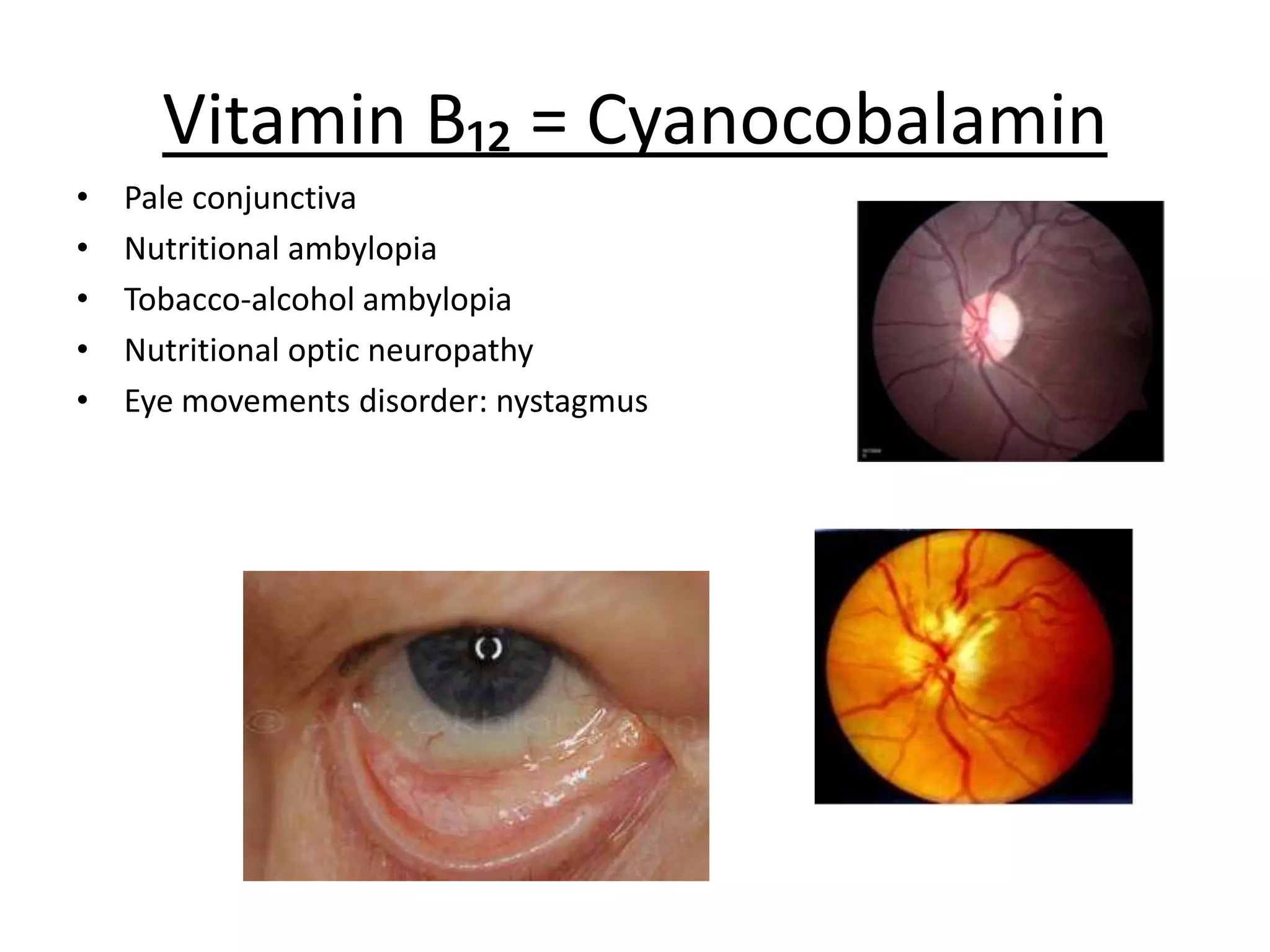 Nutrition deficiency effects on the eyes | PPTX