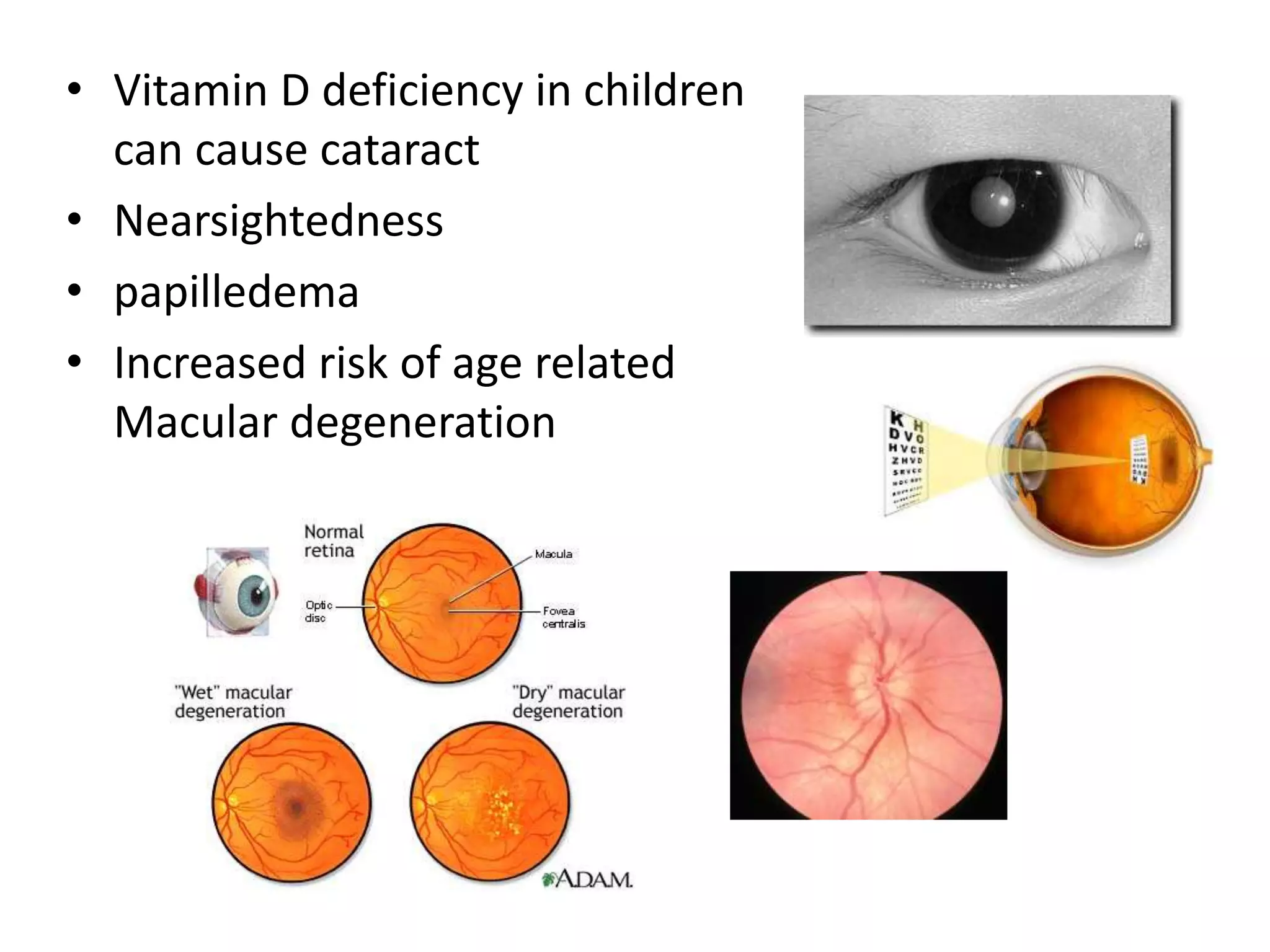 Nutrition deficiency effects on the eyes | PPTX