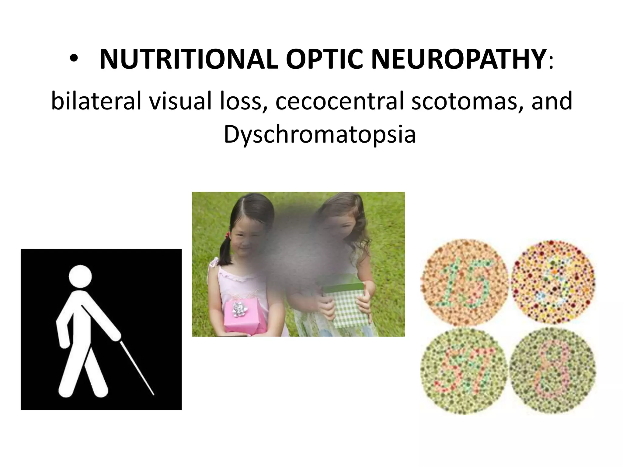 Nutrition deficiency effects on the eyes | PPTX