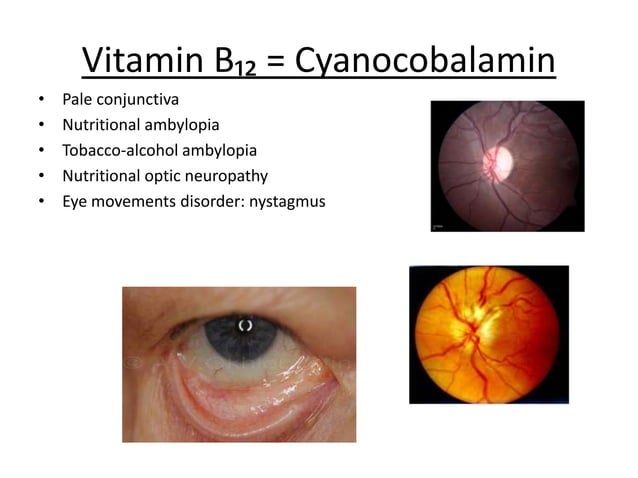 Nutrition deficiency effects on the eyes | PPTX | Eye and Vision ...
