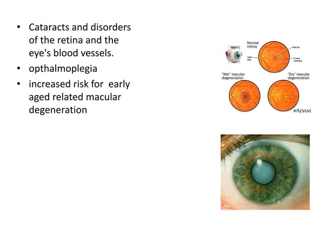 Nutrition deficiency effects on the eyes | PPTX | Eye and Vision ...