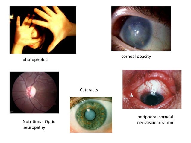 Nutrition deficiency effects on the eyes | PPTX | Eye and Vision ...