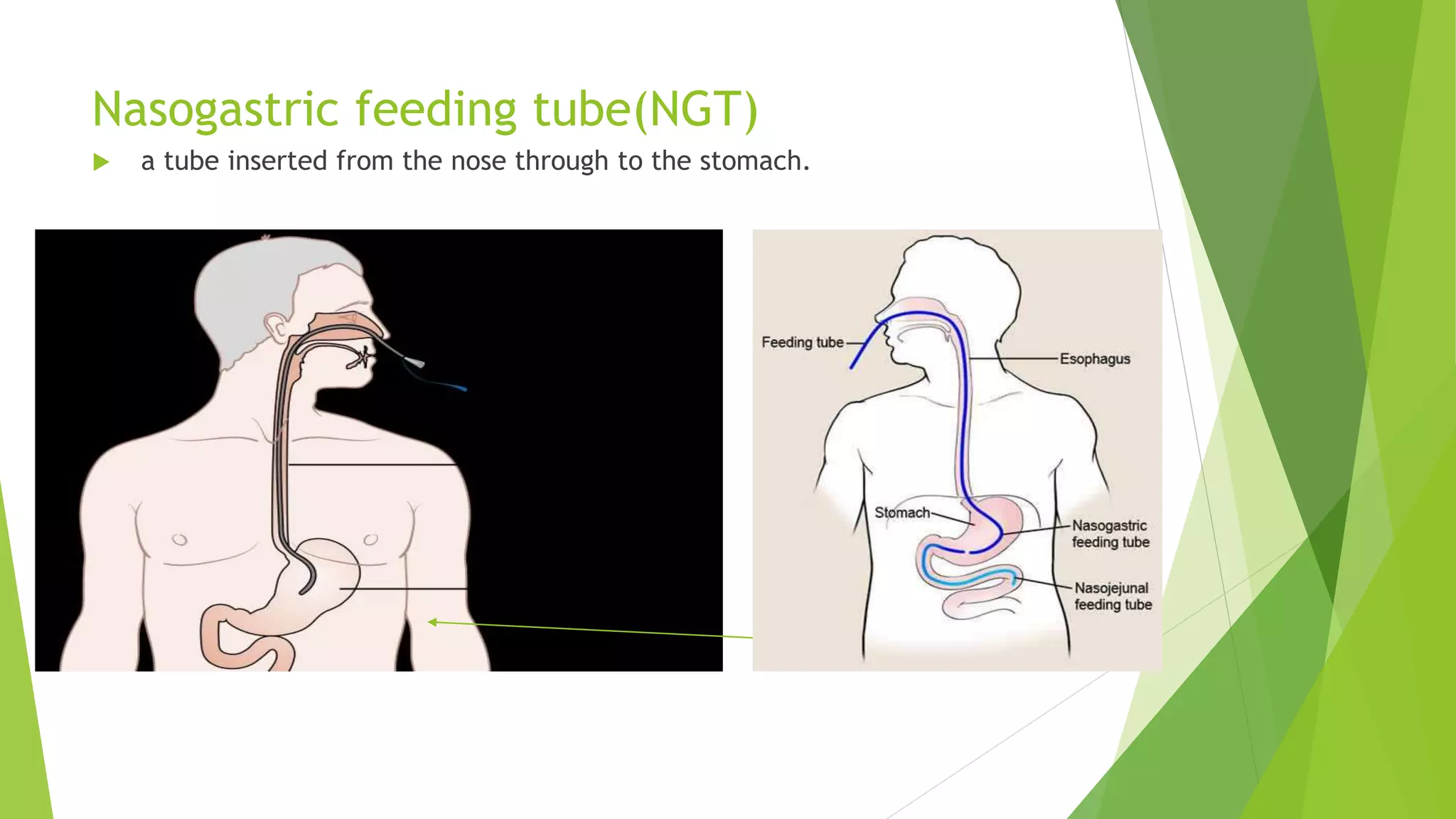 NUTRITION FEEDING MODES(parenteral ^0 enteral feeding).pptx