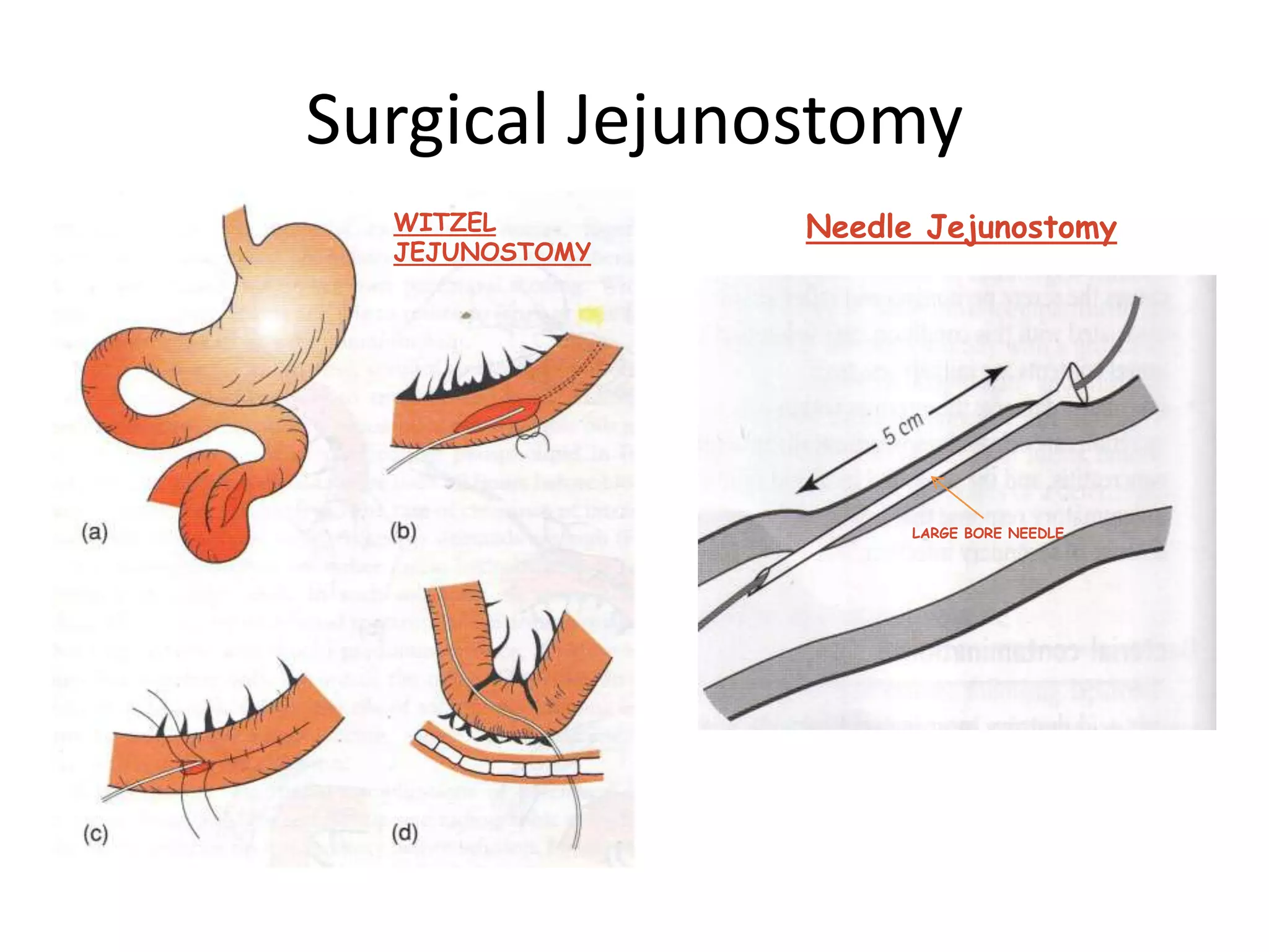 Nutrition in surgery | PPTX