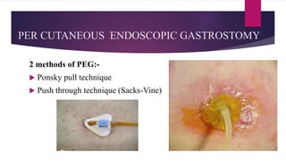 Nutrition in surgical patients | PPTX