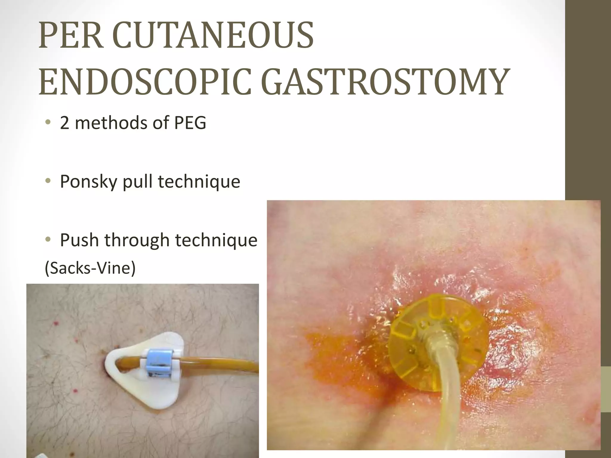 Nutrition in General Surgery | PPTX
