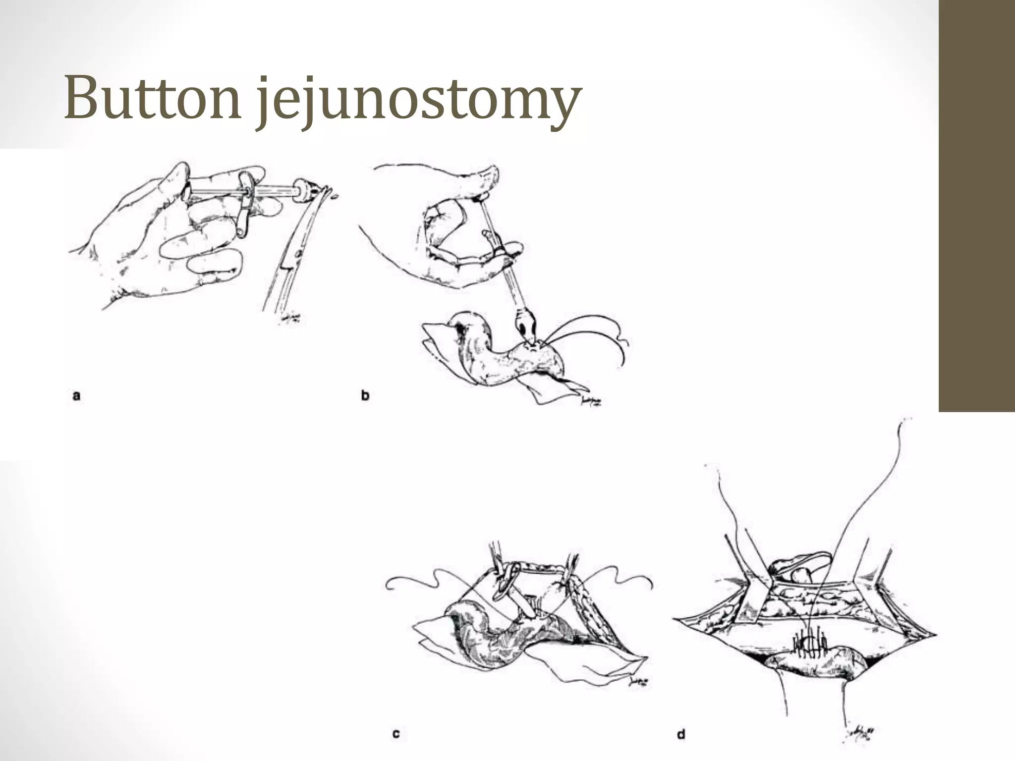 Nutrition in General Surgery | PPTX