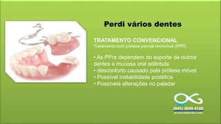 Tudo o que você precisa saber sobre implantes dentários | PPTX
