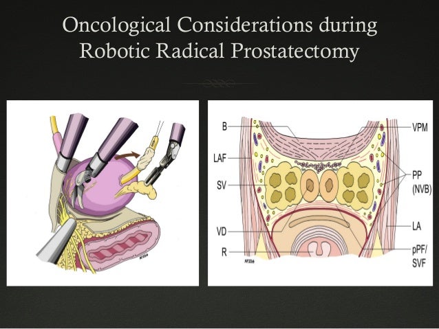 The role of Robotic Assisted laparoscopic Prostatectomy and PLND in p…
