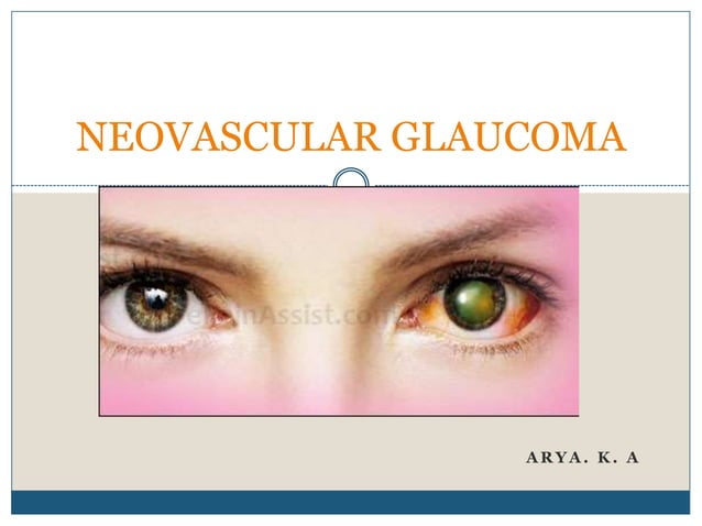 Neovascular glaucoma | PPTX | Eye and Vision Conditions | Diseases and ...