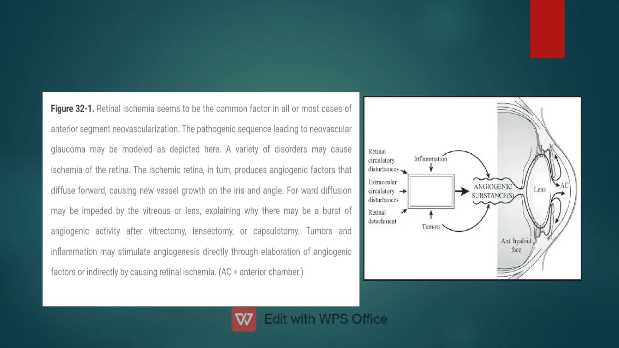Neovascular glaucoma retinal aspects.... | PDF