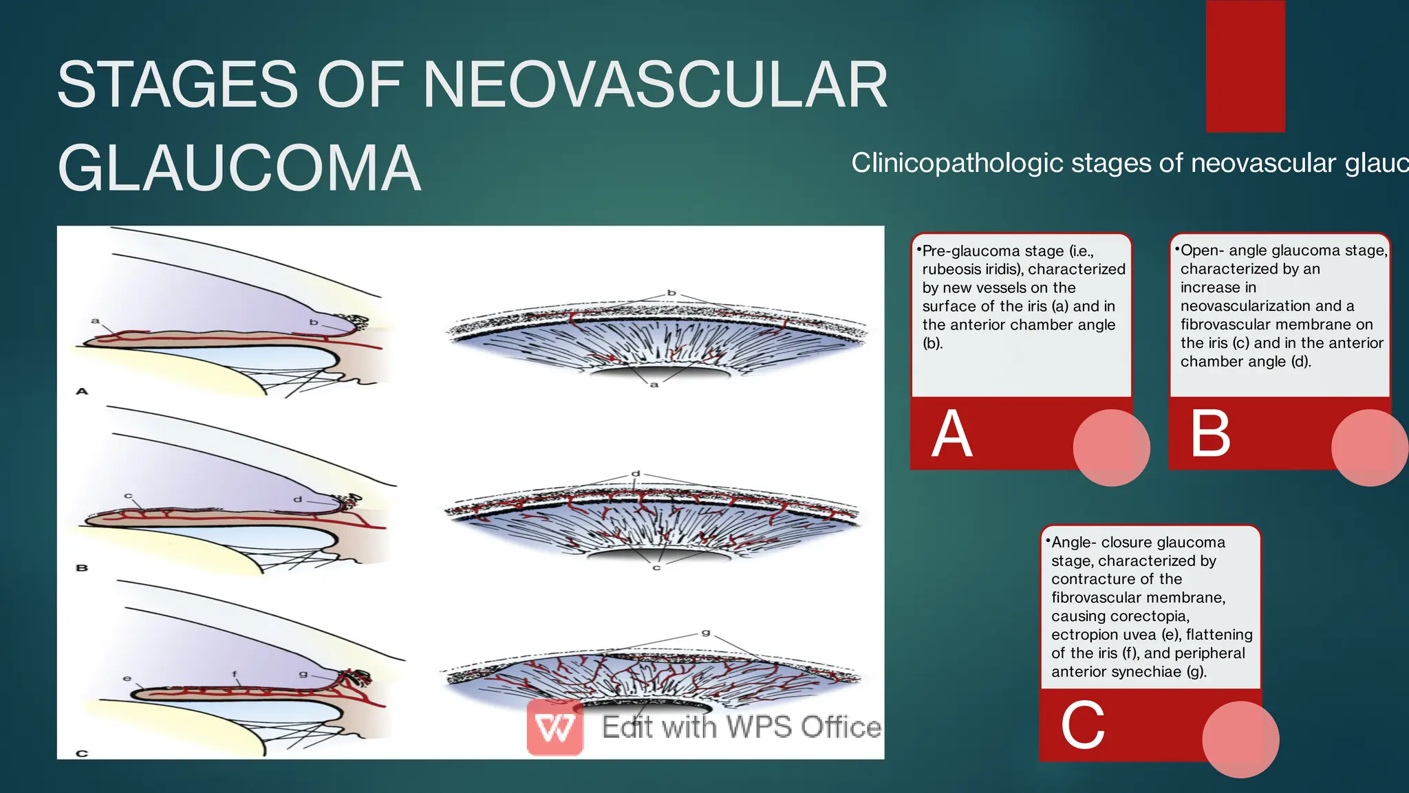 Neovascular glaucoma retinal aspects.... | PDF