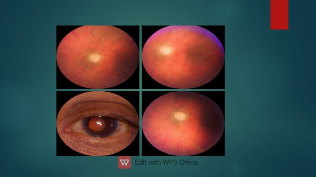 Neovascular glaucoma retinal aspects.... | PPT