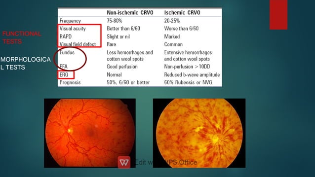 Neovascular glaucoma retinal aspects.... | PPT